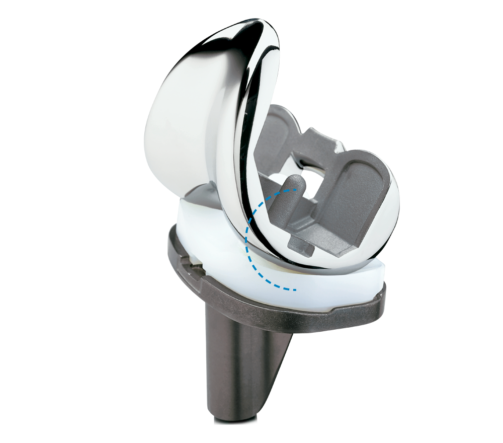 NexGen® Complete Knee Solution – Medecins Evergreen
